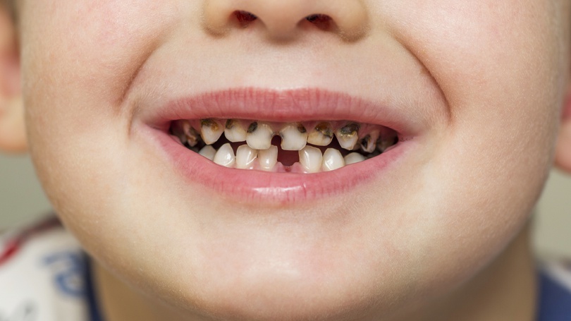 All About Cavities in Children and How to Deal With It - iCharts
