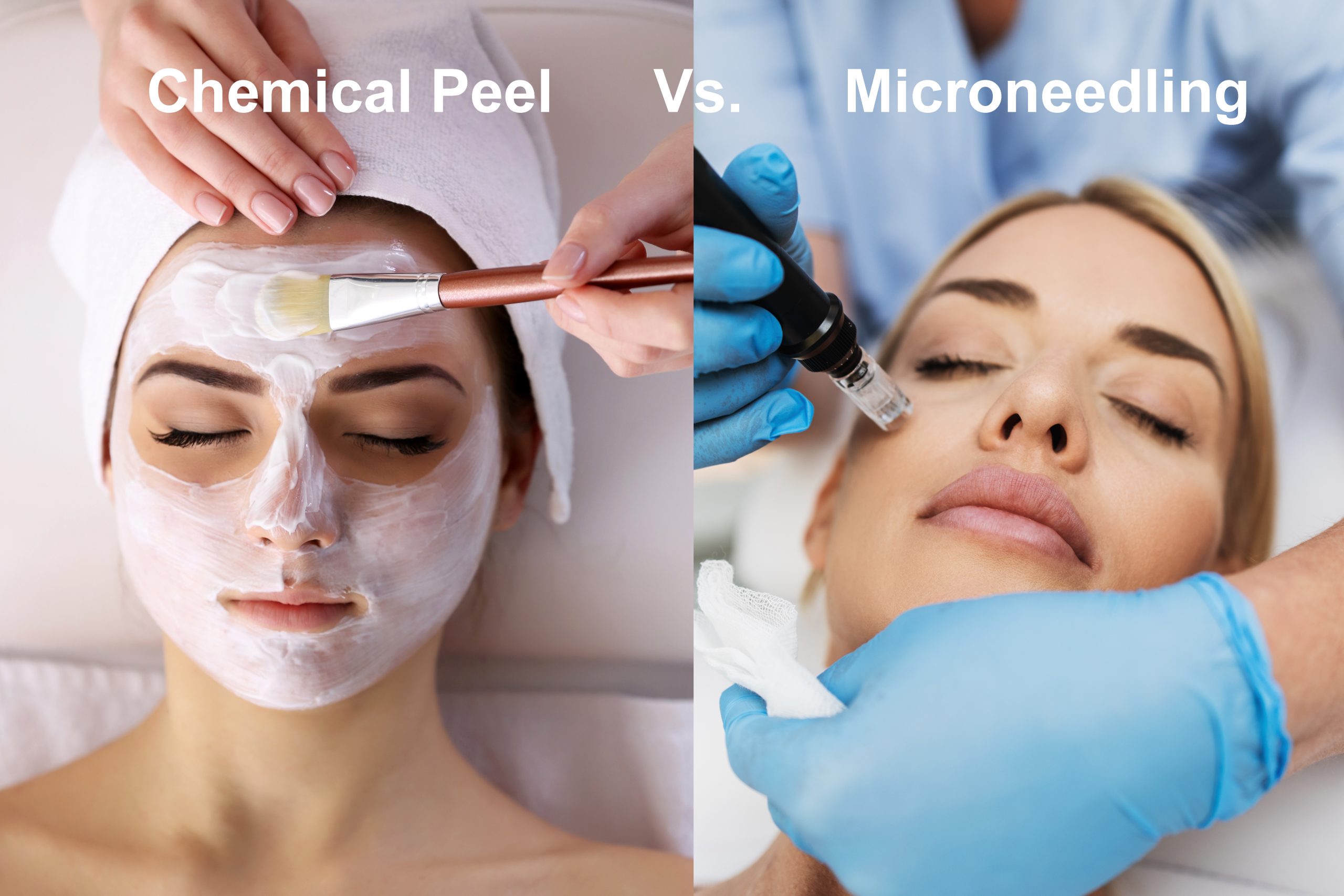 Microneedling vs. Chemical Peels: Which Rejuvenation Method is Right ...